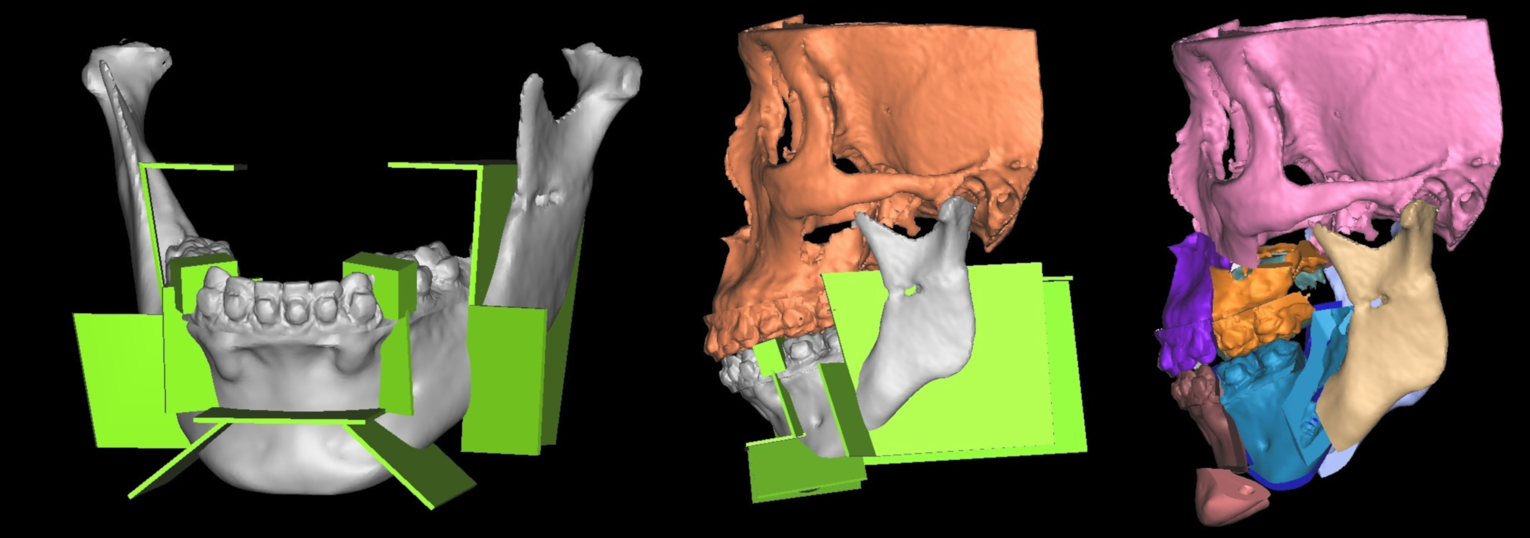Novel application of jaw advancement surgery helps treat OSA and ...